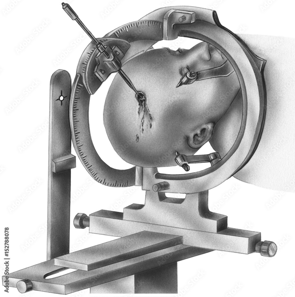 Stereotactic brain surgery is a surgical procedure where lesion is ...