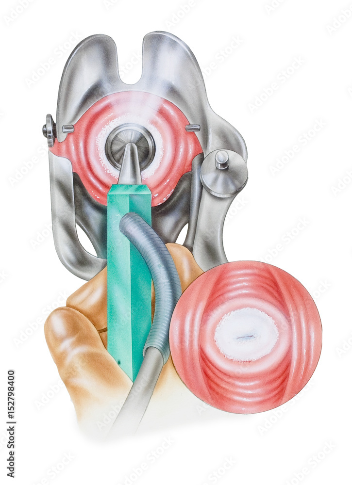 Cryosurgery to remove cervical lesions. Shown are the procedure (top ...