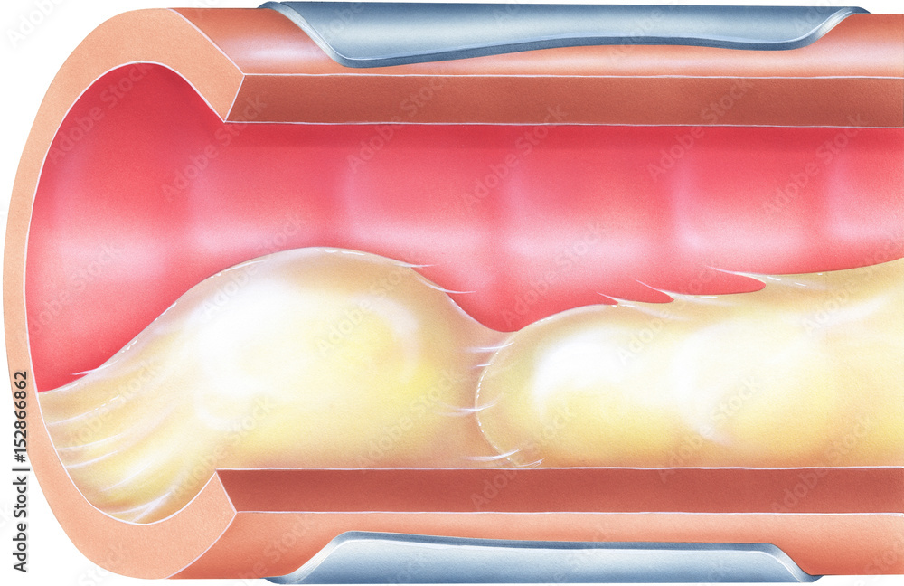 Lungs - Bronchial Mucus. Shown is bronchial airway obstruction and ...