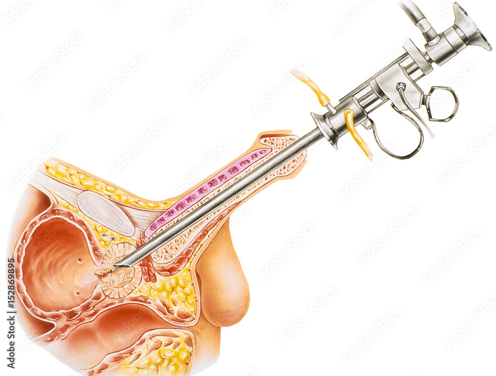 Prostate - Transurethral Resection Procedure of the prostate (TURP): Stock イラスト | Adobe Stock