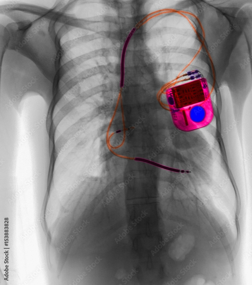 CXR with pacemaker for atrial fibrillation Stock Photo | Adobe Stock