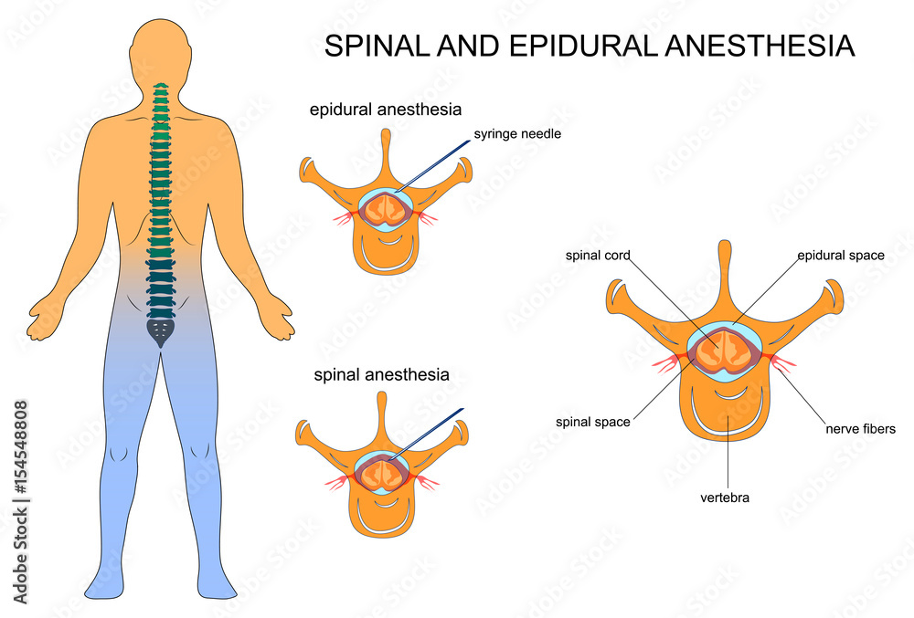 epidural and spinal anaesthesia Stock Vector | Adobe Stock
