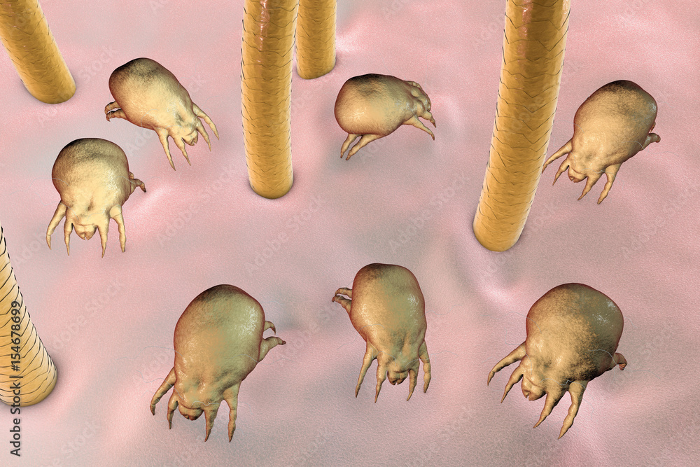 Dust mites Dermatophagoides on human skin with hairs, parasites which ...