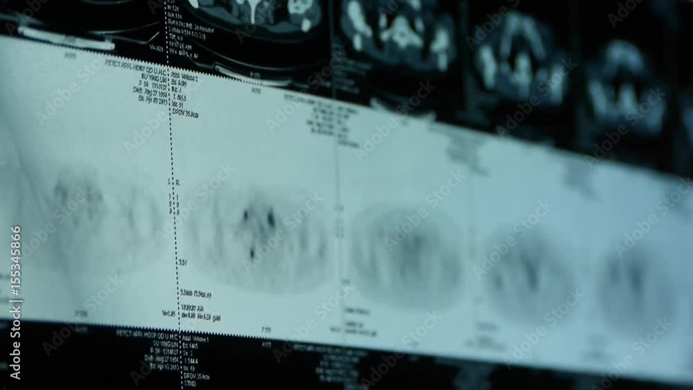 human subclavian pet-ct scan,lymph nodes X-ray,Cancer metastasis. Stock ...