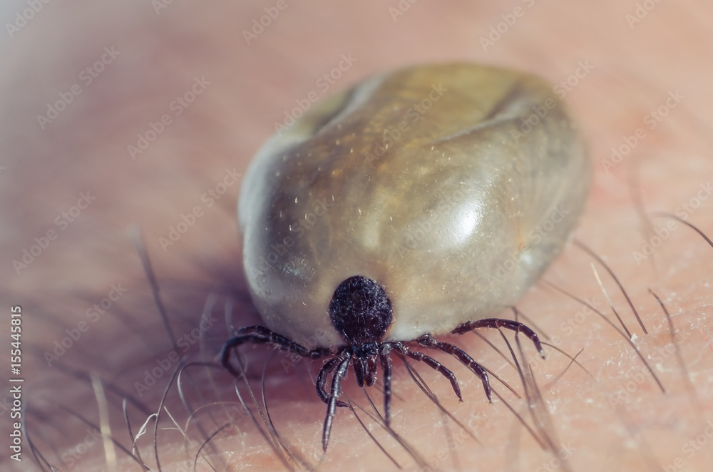 Tick filled with blood sitting on human skin Stock Photo | Adobe Stock