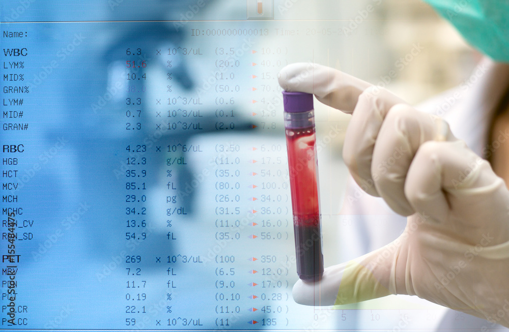 scientist do blood inspection and background with its report in ...