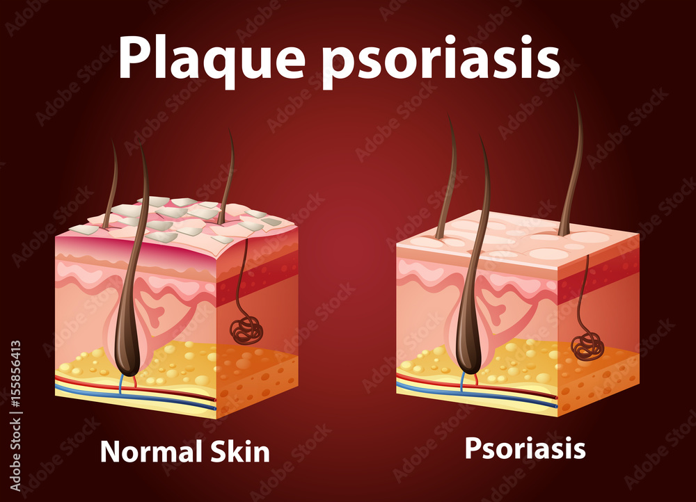 Diagram showing plaque psoriasis Stock Vector | Adobe Stock