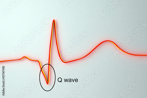 Pathological Q Wave