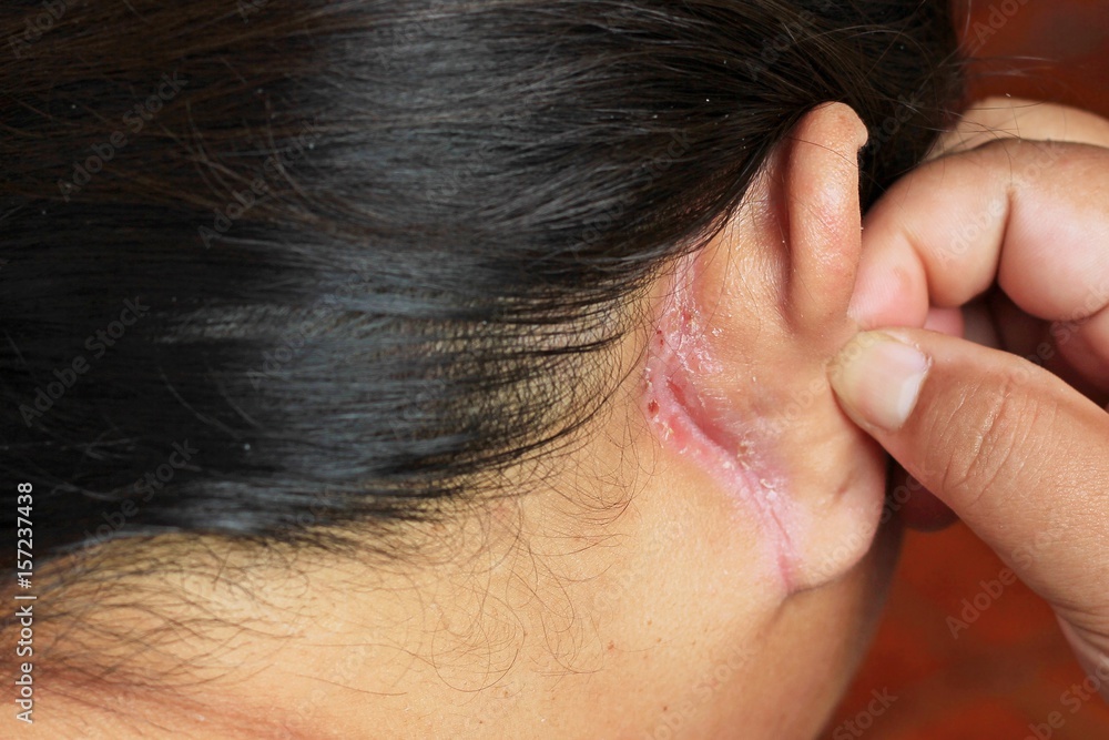 wound behind ear Stock Photo | Adobe Stock
