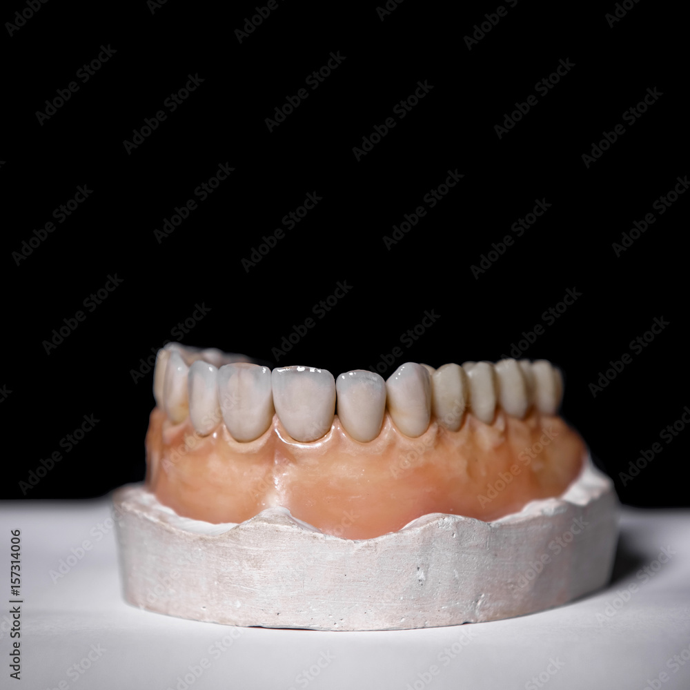 Ceramic teeth dental crowns on model, metal free - front view . Ceramic ...