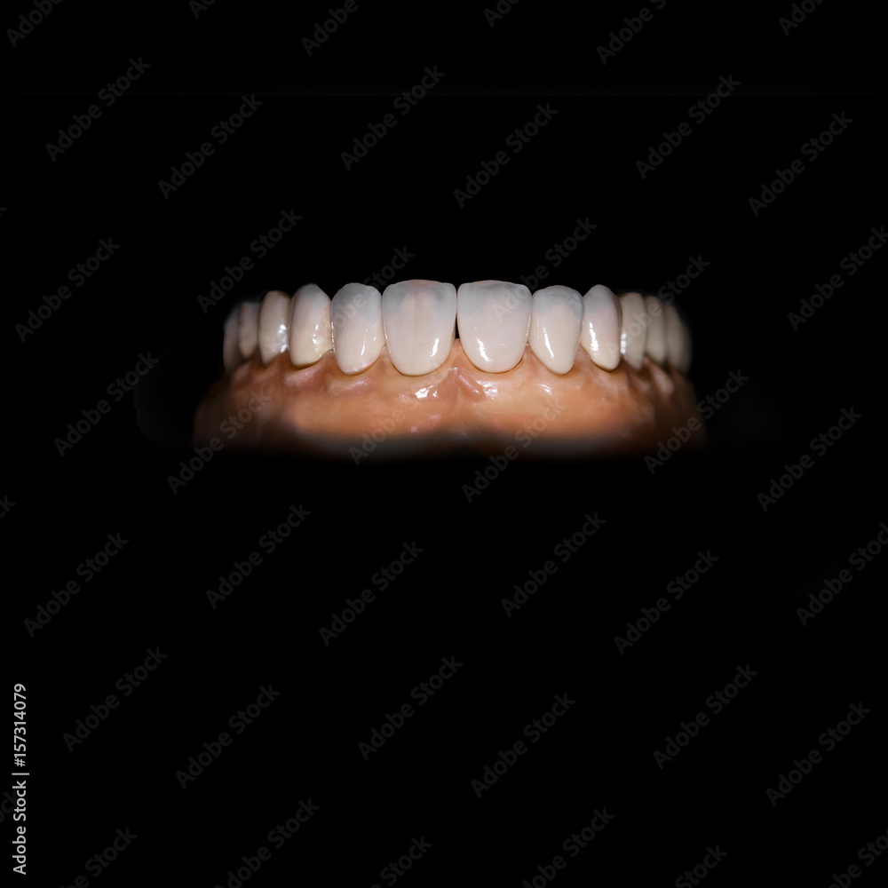 Ceramic teeth dental crowns on model, metal free - front view . Ceramic ...