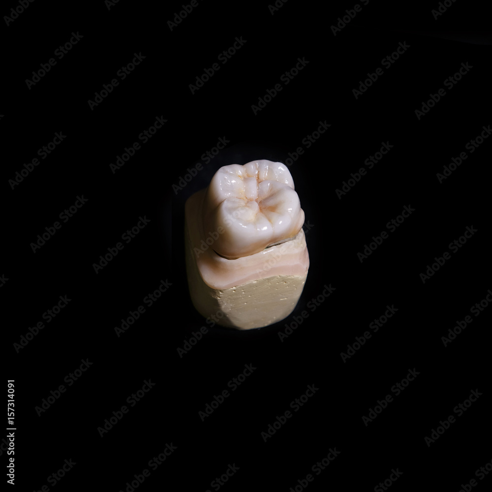 Ceramic teeth dental crowns on model, metal free - front view . Ceramic ...