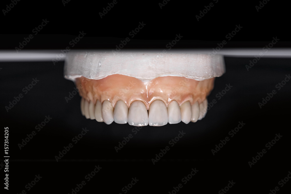 Ceramic teeth dental crowns on model, metal free - front view . Ceramic ...