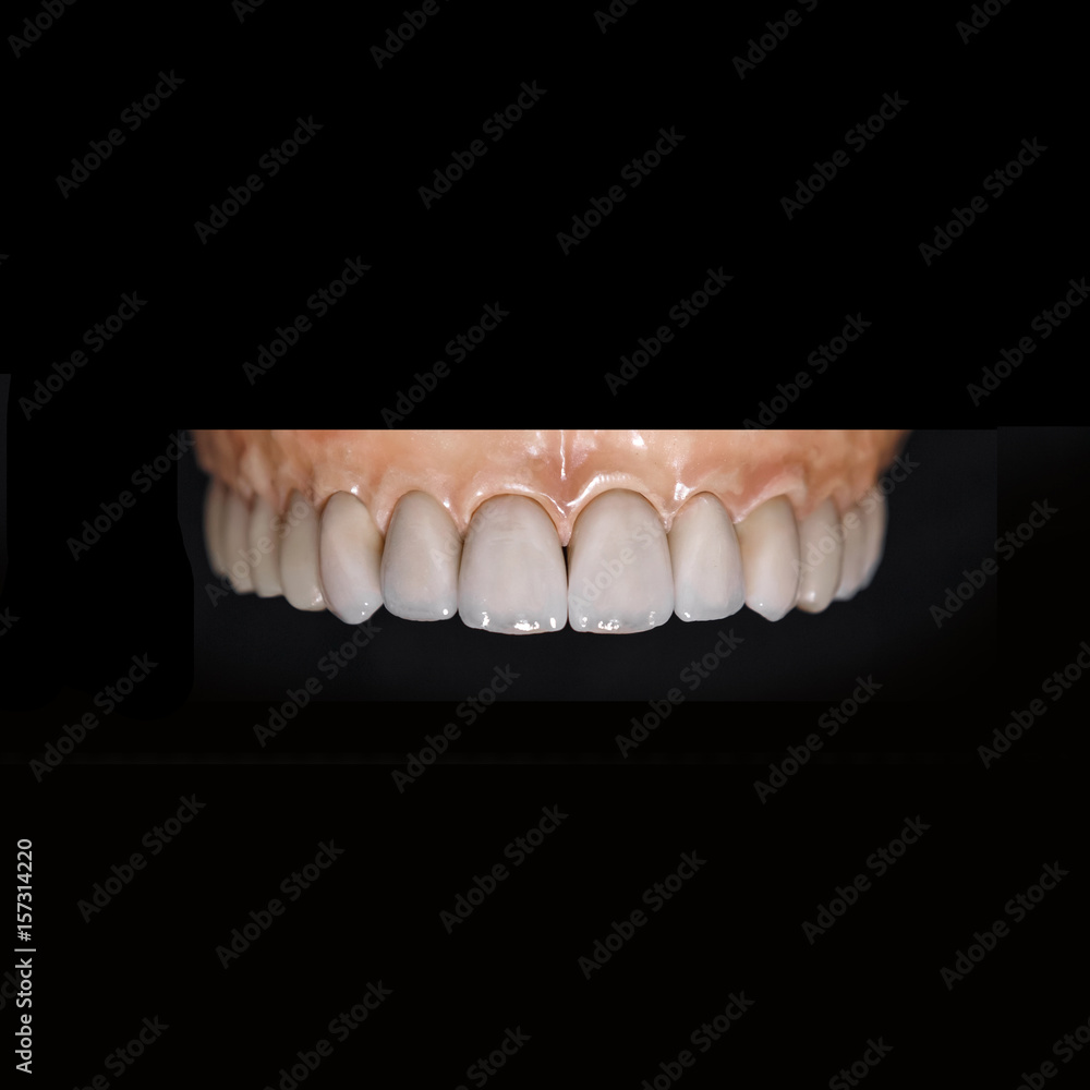 Ceramic teeth dental crowns on model, metal free - front view . Ceramic ...