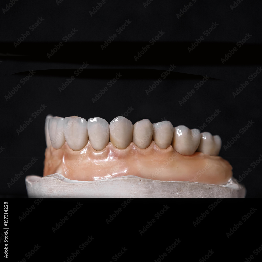 Ceramic teeth dental crowns on model, metal free - front view . Ceramic ...
