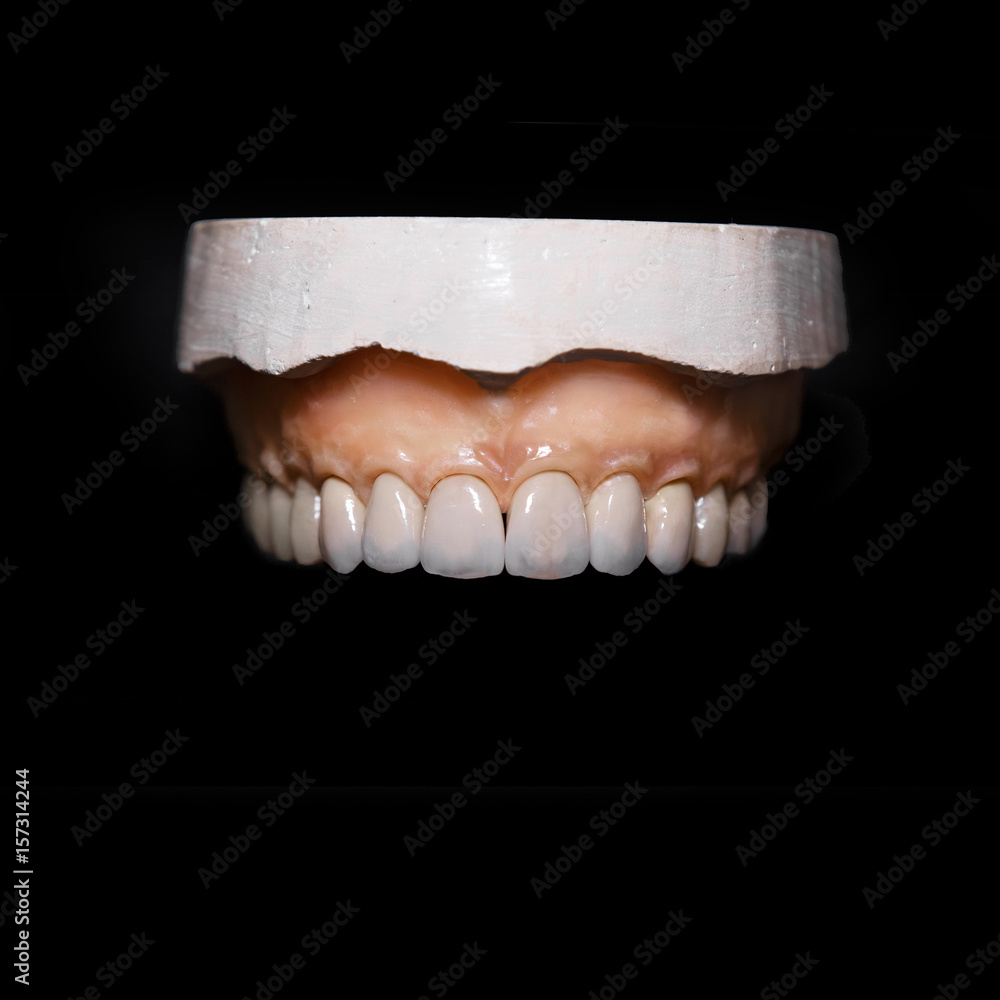 Ceramic teeth dental crowns on model, metal free - front view . Ceramic ...