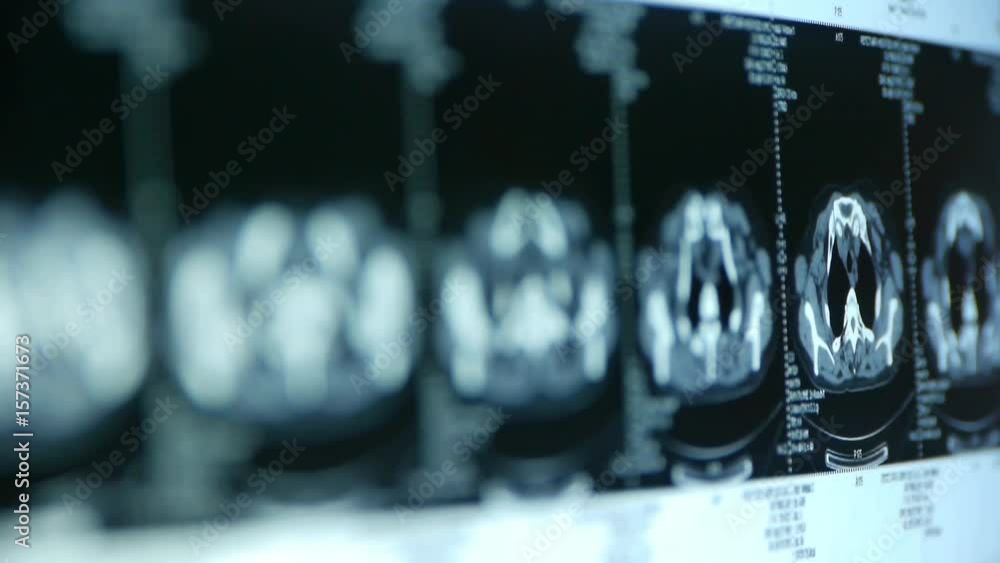 human subclavian pet-ct scan,lymph nodes X-ray,Cancer metastasis. Stock ...