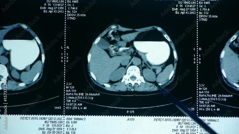 doctor study Gallbladder pet-ct scan,human organ X-ray radiography ...