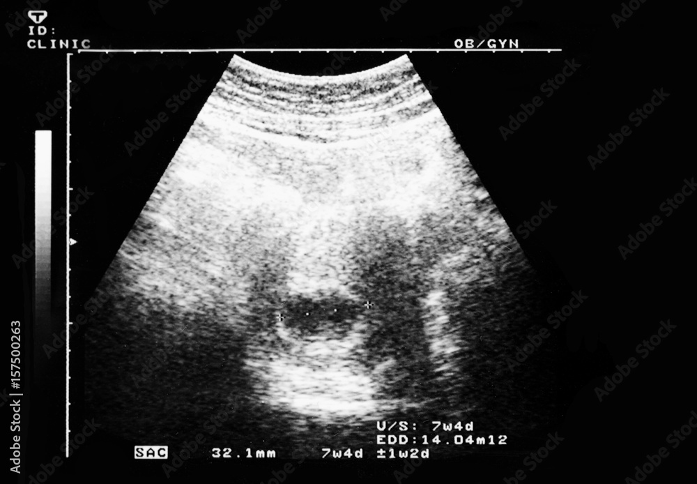 An ultrasound of a human fetus during the 7th week. Stock Photo | Adobe ...