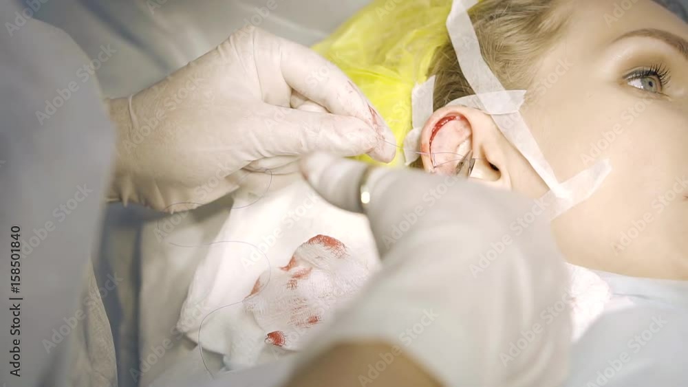 Closeup surgery otoplasty corrects protruding ears., the operation ...
