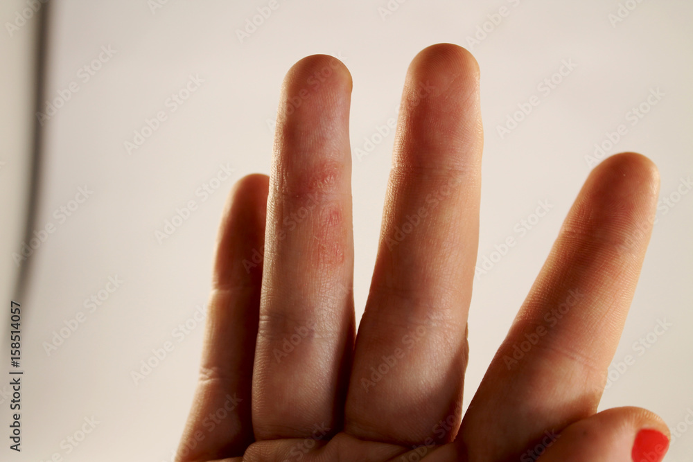 Allergic rash dermatitis, skin eczema patient. Hands of beautiful girl ...