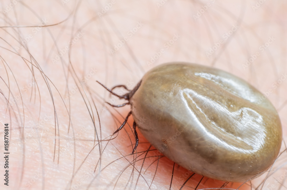 Tick filled with blood sitting on human skin Stock Photo | Adobe Stock