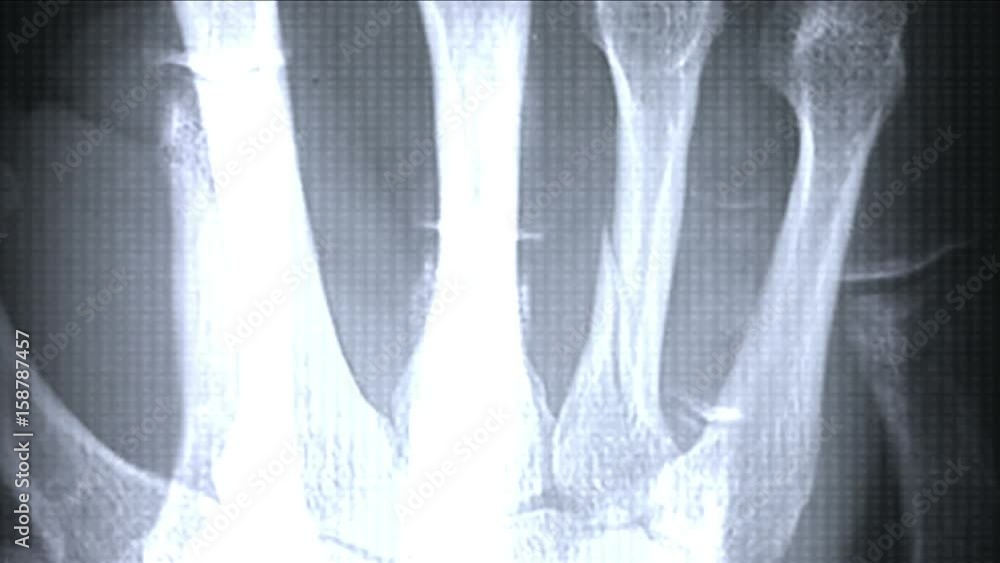 Vidéo Stock 4k Human rib finger bones scan,tech medical X-ray scanning ...