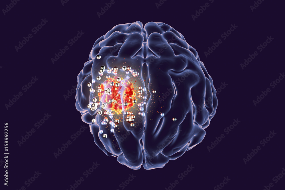 Brain Cancer Cells