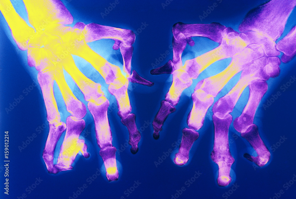 Rheumatoid arthritis, x-ray Stock Photo | Adobe Stock