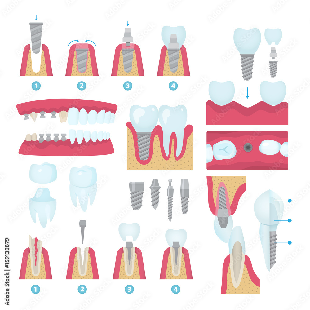 Set of dental crowns and implantation prosthodontics elements and tools ...