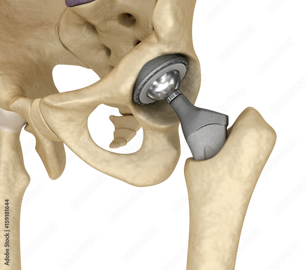 Hip replacement implant installed in the pelvis bone. Medically ...