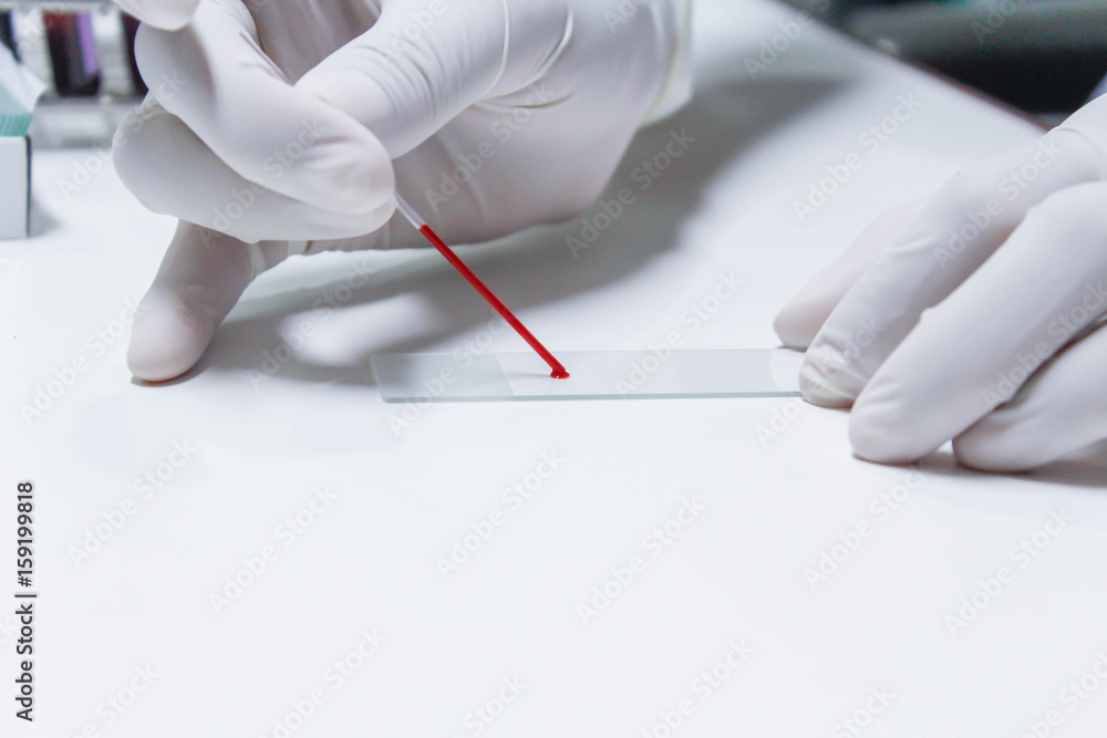 sample for blood smear method Stock Photo | Adobe Stock