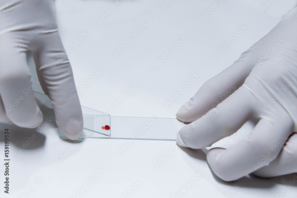 sample for blood smear method Stock Photo | Adobe Stock