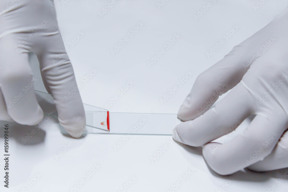 sample for blood smear method Stock Photo | Adobe Stock