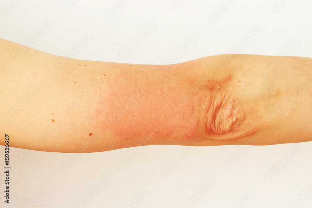 Red pustules and vesicles on the skin of the hand as symptoms of ...
