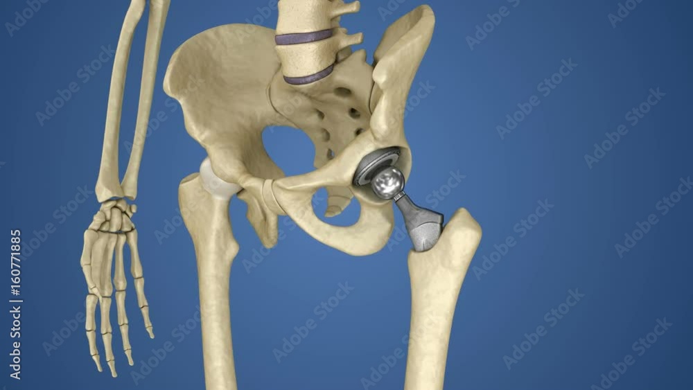 Hip replacement implant installed in the pelvis bone. Medically ...