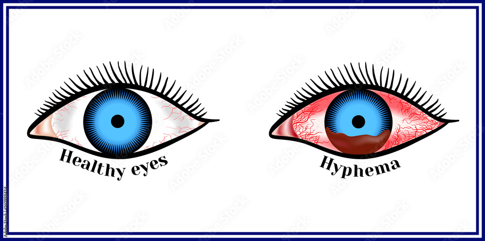 Hyphema - hemorrhage in the anterior chamber of the eye. Stock Vector ...