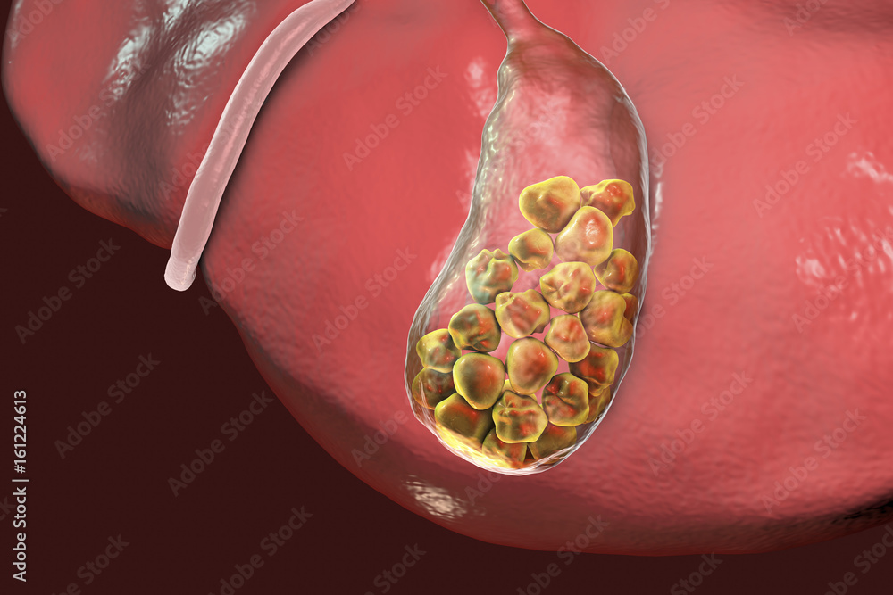 Gallstones, 3D illustration showing bottom view of liver and ...