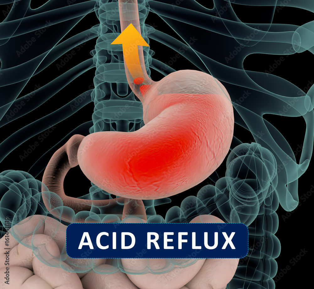 Acid reflux, GERD. Gastroesophageal reflux disease. Diagram with title ...