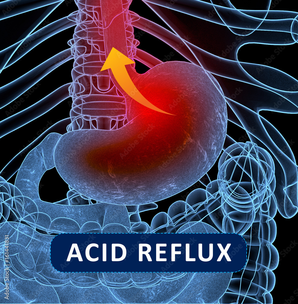 Acid Reflux Gerd Gastroesophageal Reflux Disease Diagram With Title