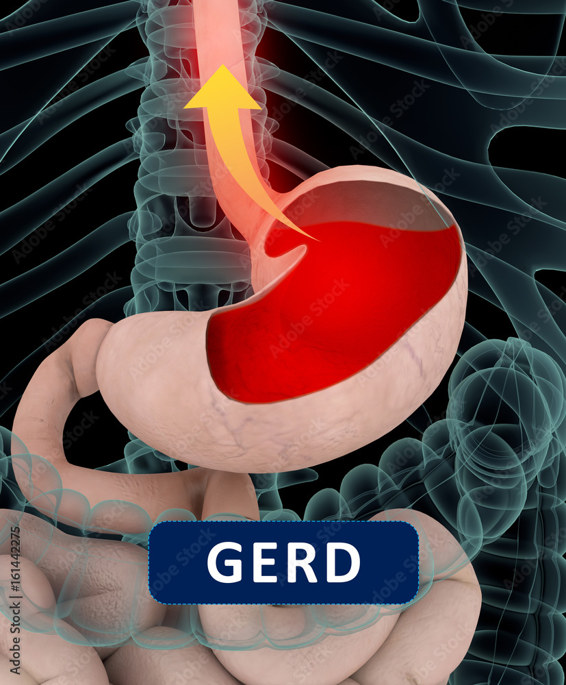 Acid reflux, GERD. Gastroesophageal reflux disease. Diagram with title ...