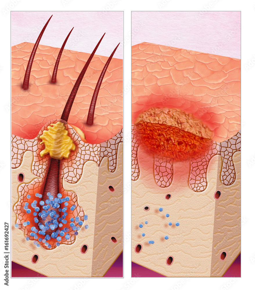 obstrucción del folículo piloso ilustración de Stock | Adobe Stock
