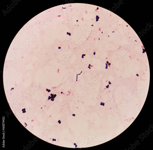 Smear of human blood cultured Gram's stained with gram positive cocci ...