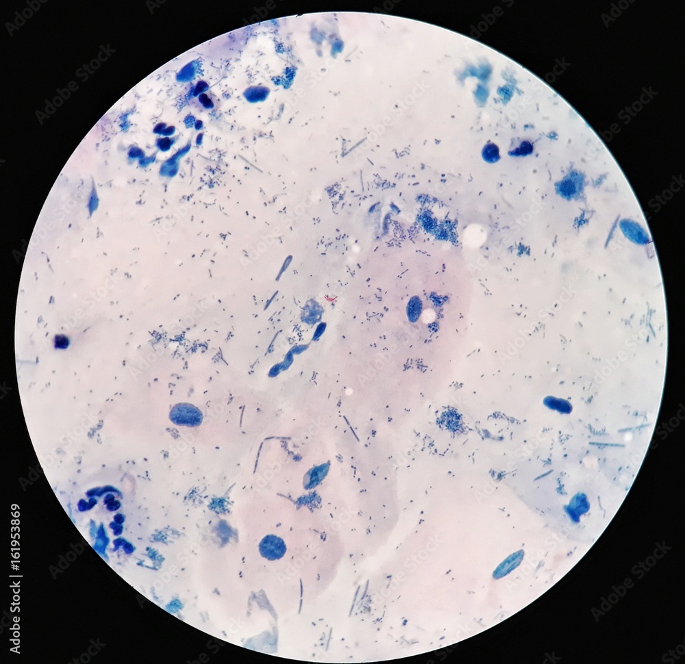 Smear of Acid-Fast bacilli (AFB) stained from sputum specimen with ...