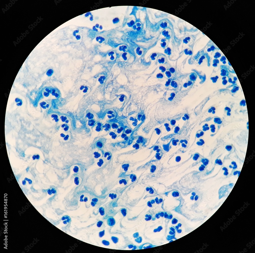Smear of Acid-Fast bacilli (AFB) stained from sputum specimen with ...