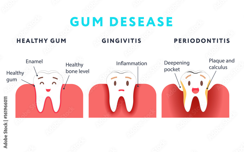 Step of gum disease. Healthy tooth and gingivitis.. Cute cartoon design ...