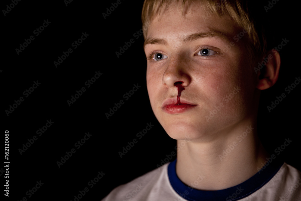 Young blond boy with bloody nose Stock Photo | Adobe Stock