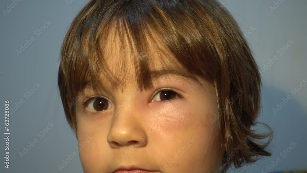 4K Distorted face of child with allergic reaction to a bee bite Stock ...