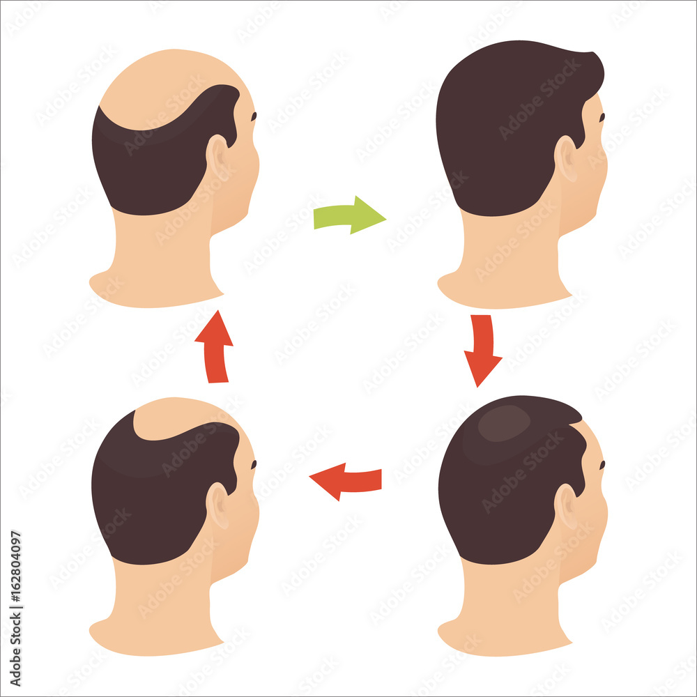 Hair Loss Stages Set Of Four Steps Side View Of A Man Losing Hair