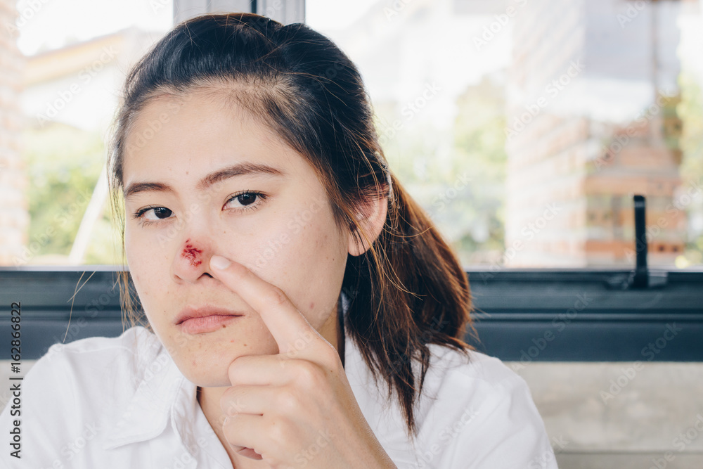 Poster The Herpes simplex on asian woman nose, Herpes simplex is a ...